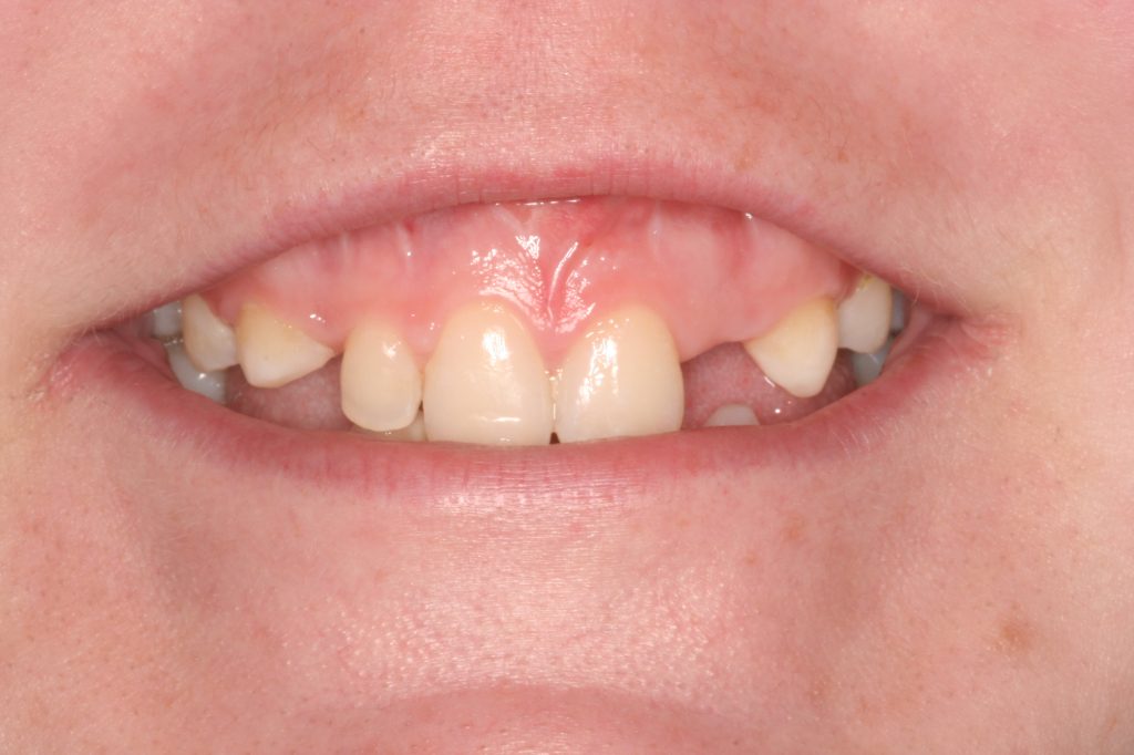 Clinical tips: smile line assessment - Irish Dentistry Clinical tips: smile line assessment - Irish Dentistry